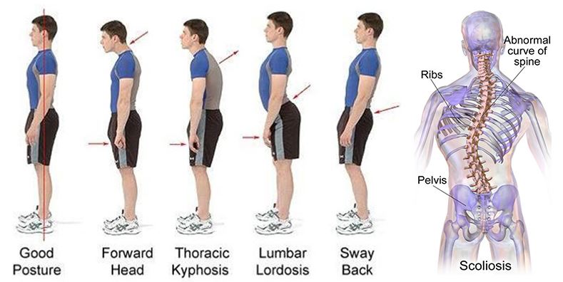 Posture Correction in Delhi, India I Dr.Ashwani Maichand