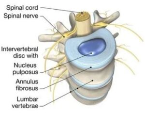 Prolapsed Intervertebral Disc (PIVD): Causes, Symptoms, Diagnosis ...