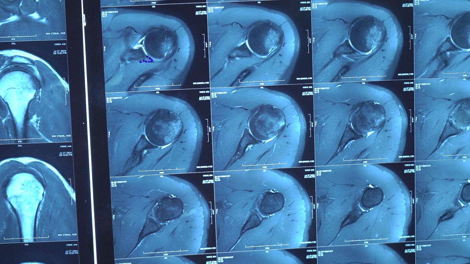 Prolapsed Intervertebral Disc (PIVD): Causes, Symptoms, Diagnosis ...